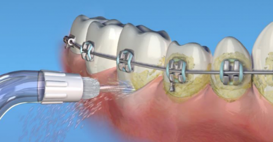 Review máy tăm nước Waterbeam cho người niềng răng | Up Dental