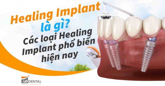 Healing Implant là gì? Các loại Healing Implant phổ biến hiện nay | Up ...